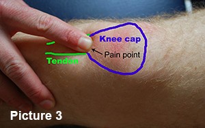 Patella Tendon Issues And How To Fix Them | realbuzz.com